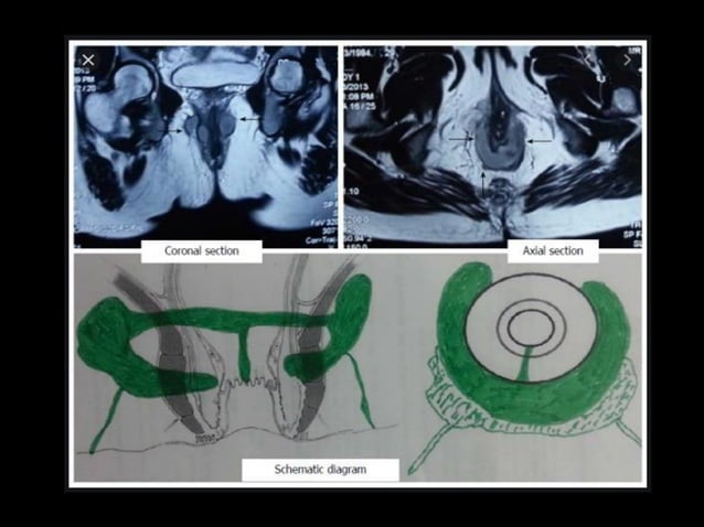 MRI fistulogram | PDF