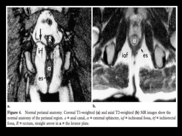 MRI fistulogram | PDF