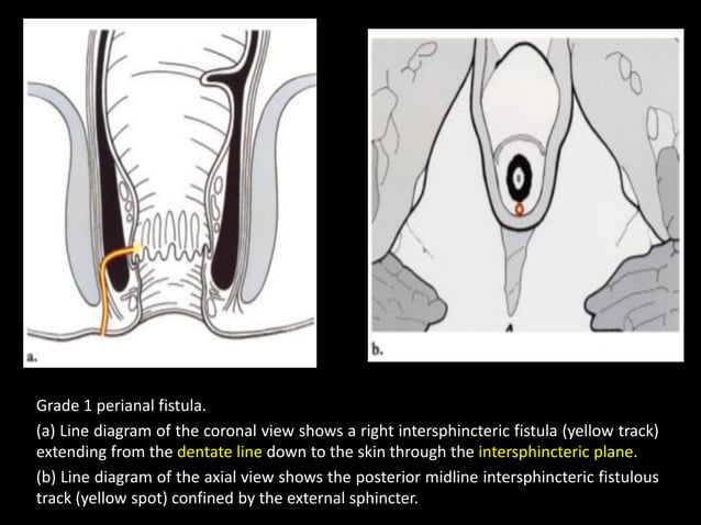 MRI fistulogram | PDF
