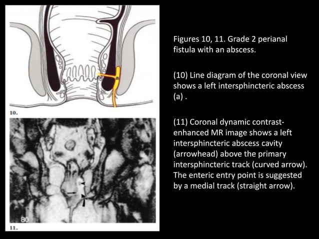 MRI fistulogram | PDF