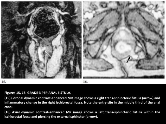 MRI fistulogram | PDF