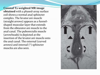 Mri for identifying types of fistulae | PPTX