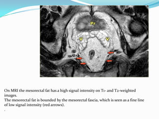 Mri for identifying types of fistulae | PPTX
