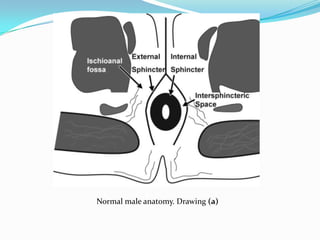 Mri for identifying types of fistulae | PPTX