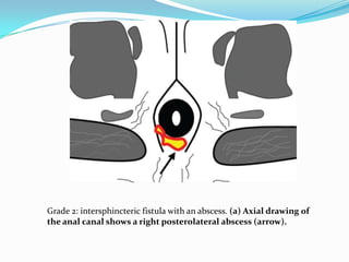 Mri for identifying types of fistulae | PPTX