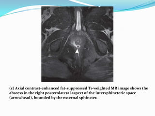 Mri for identifying types of fistulae | PPTX