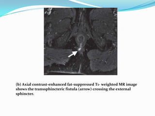 Mri for identifying types of fistulae | PPTX