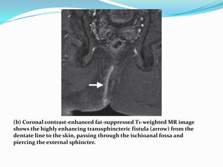 Mri for identifying types of fistulae | PPTX