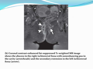 Mri for identifying types of fistulae | PPTX