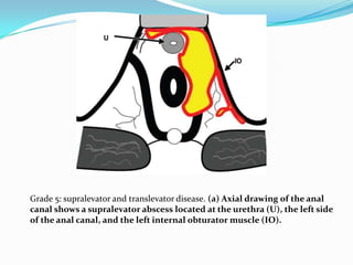 Mri for identifying types of fistulae | PPTX