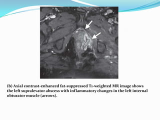 Mri for identifying types of fistulae | PPTX