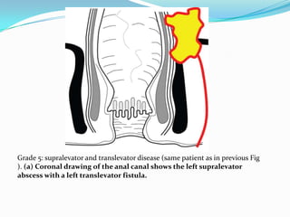 Mri for identifying types of fistulae | PPTX