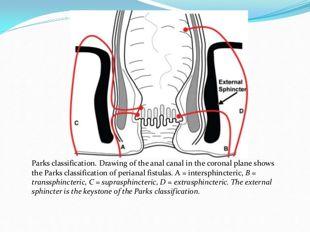 Mri for identifying types of fistulae