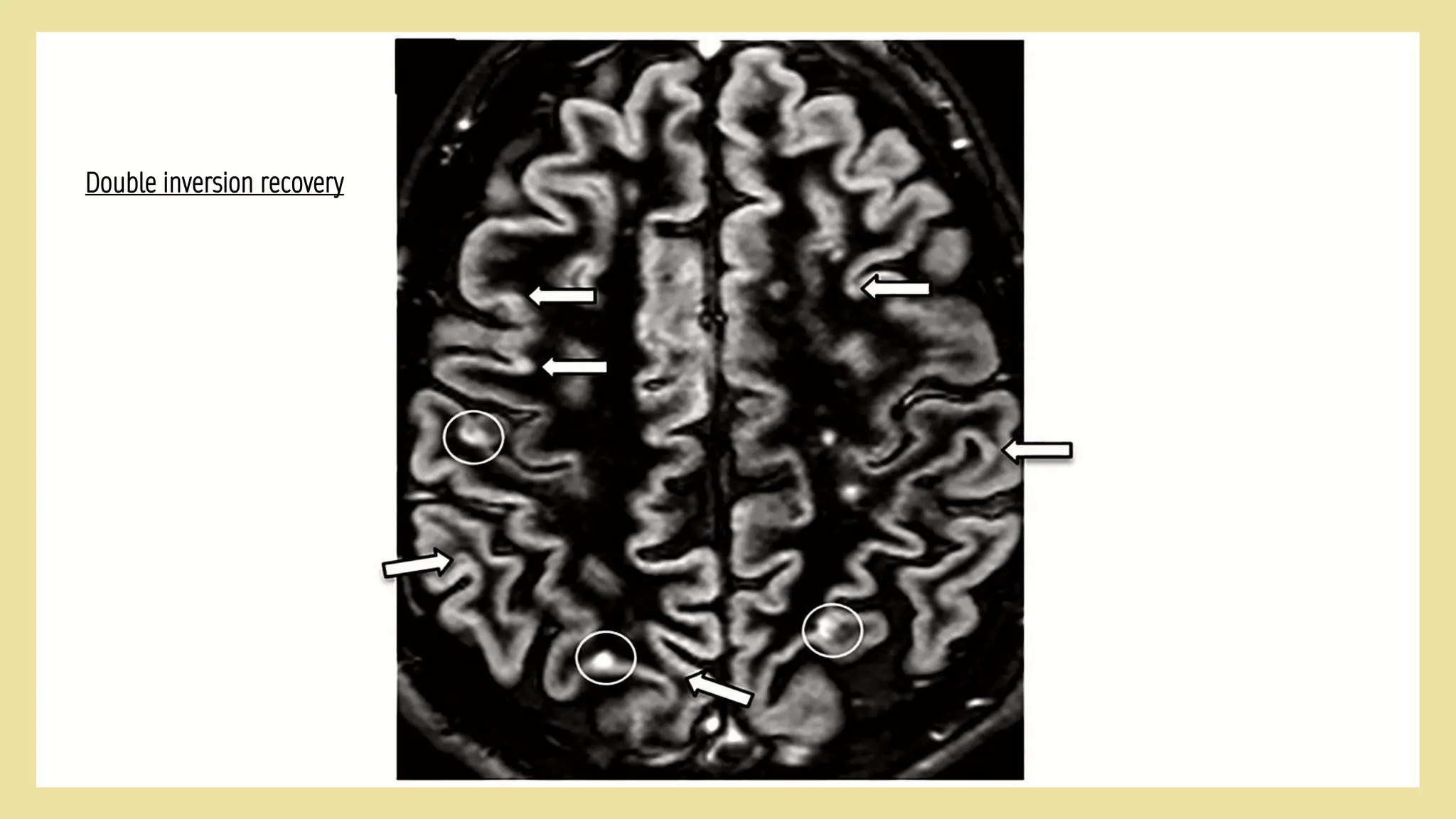 MRI for Physiotherapy | PDF