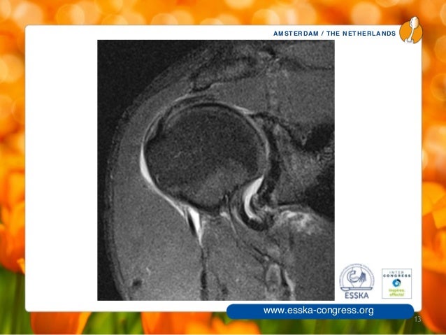 Shoulder MRI for Surgeons