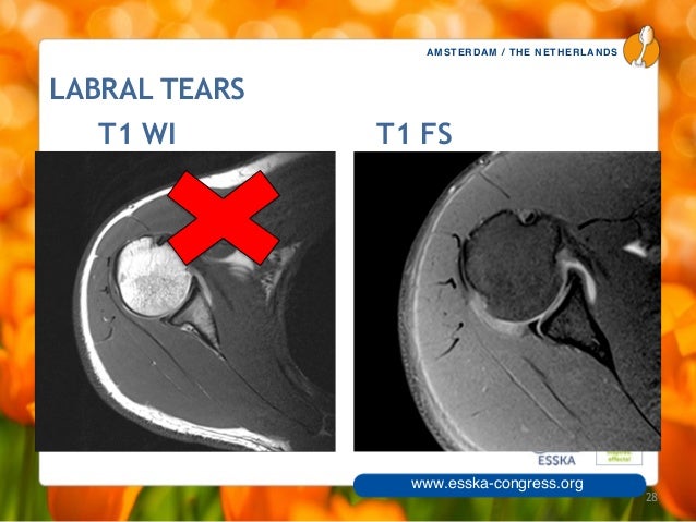 Shoulder MRI for Surgeons