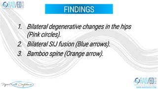 ANKYLOSING SPONDYLITIS PERIPHERAL JOINT HIP INVOLVEMENT RADEDASIA | PDF