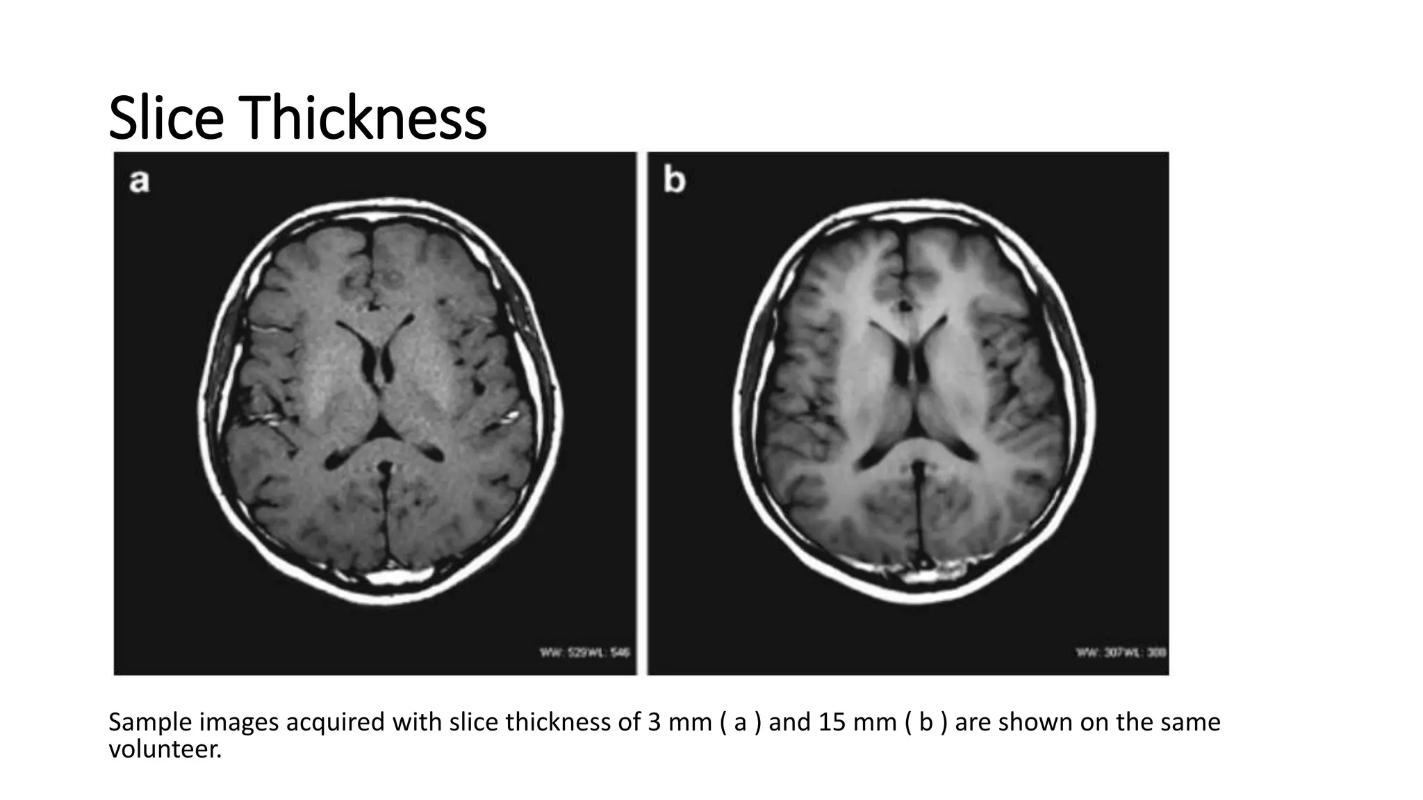 MRI IMAGE QUALITY and Factors affecting it by T.R.B. | PPTX