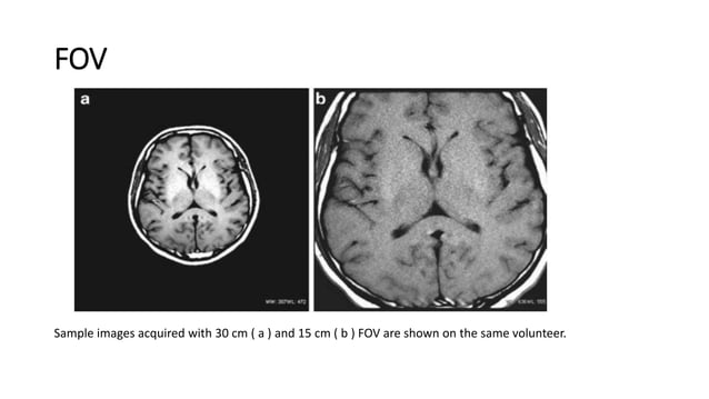 MRI IMAGE QUALITY and Factors affecting it by T.R.B. | PPTX | 3-D ...