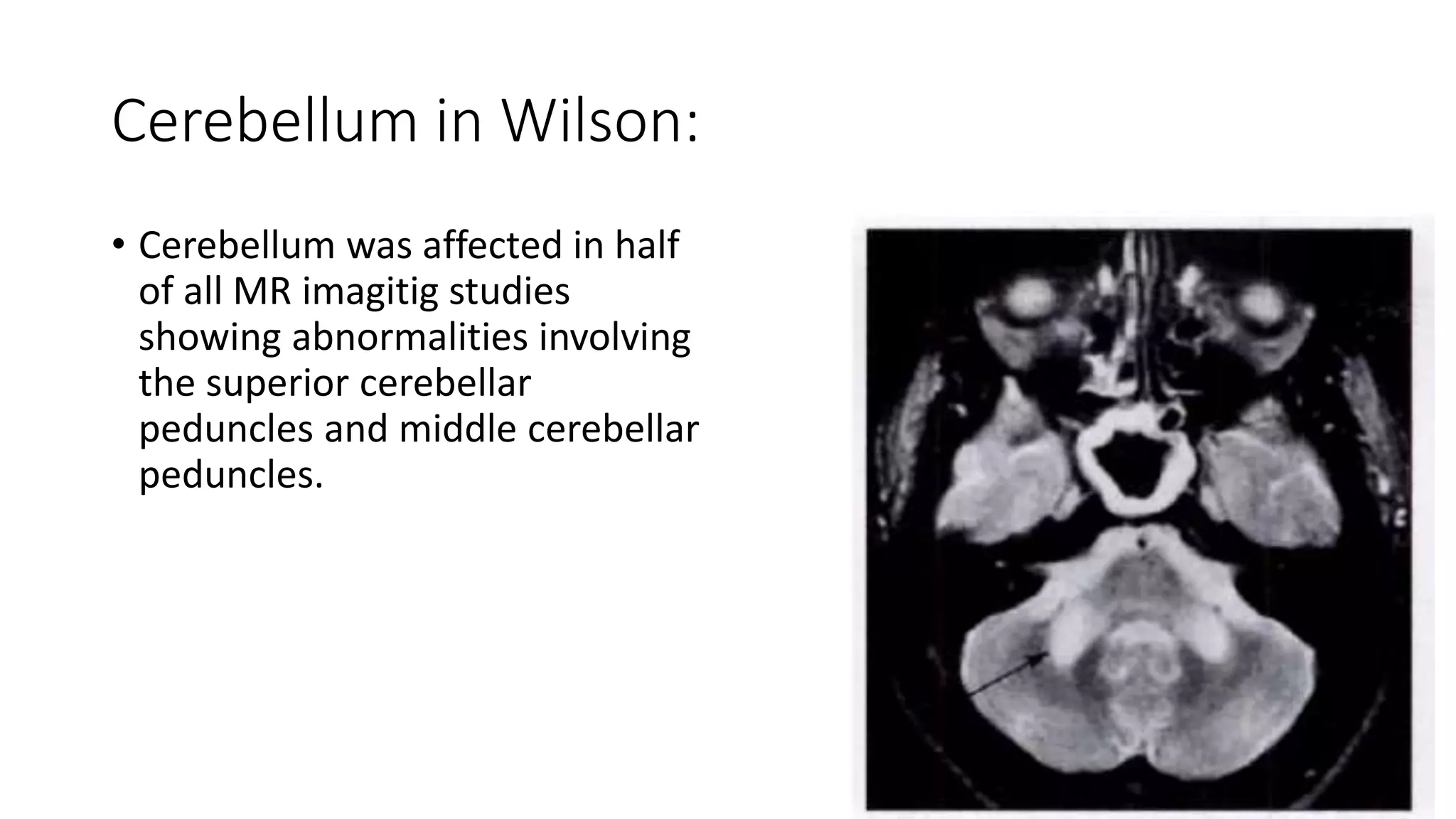 Mri imaging finding in wilson disease | PPTX