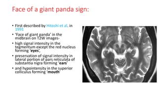 Mri imaging finding in wilson disease | PPT