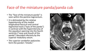 Mri imaging finding in wilson disease | PPTX