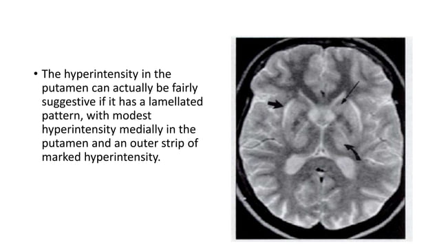 Mri imaging finding in wilson disease | PPT