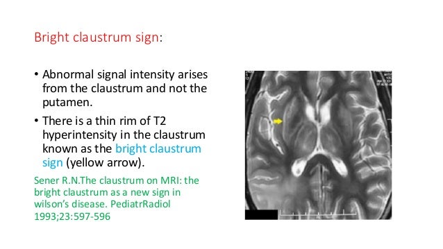 Mri imaging finding in wilson disease