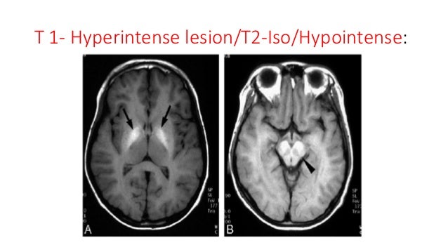 Mri imaging finding in wilson disease