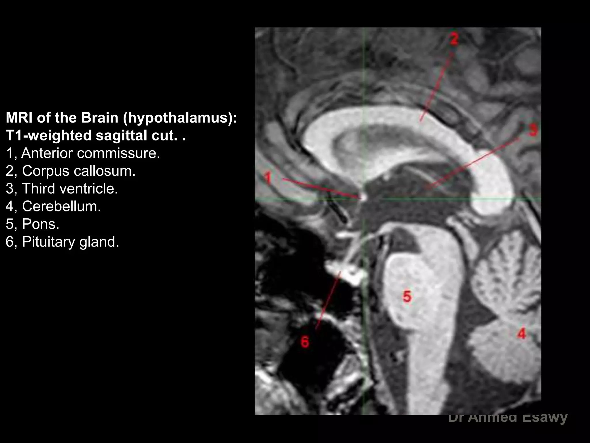 MRI imaging hypothalamus Dr Ahmed Esawy | PDF