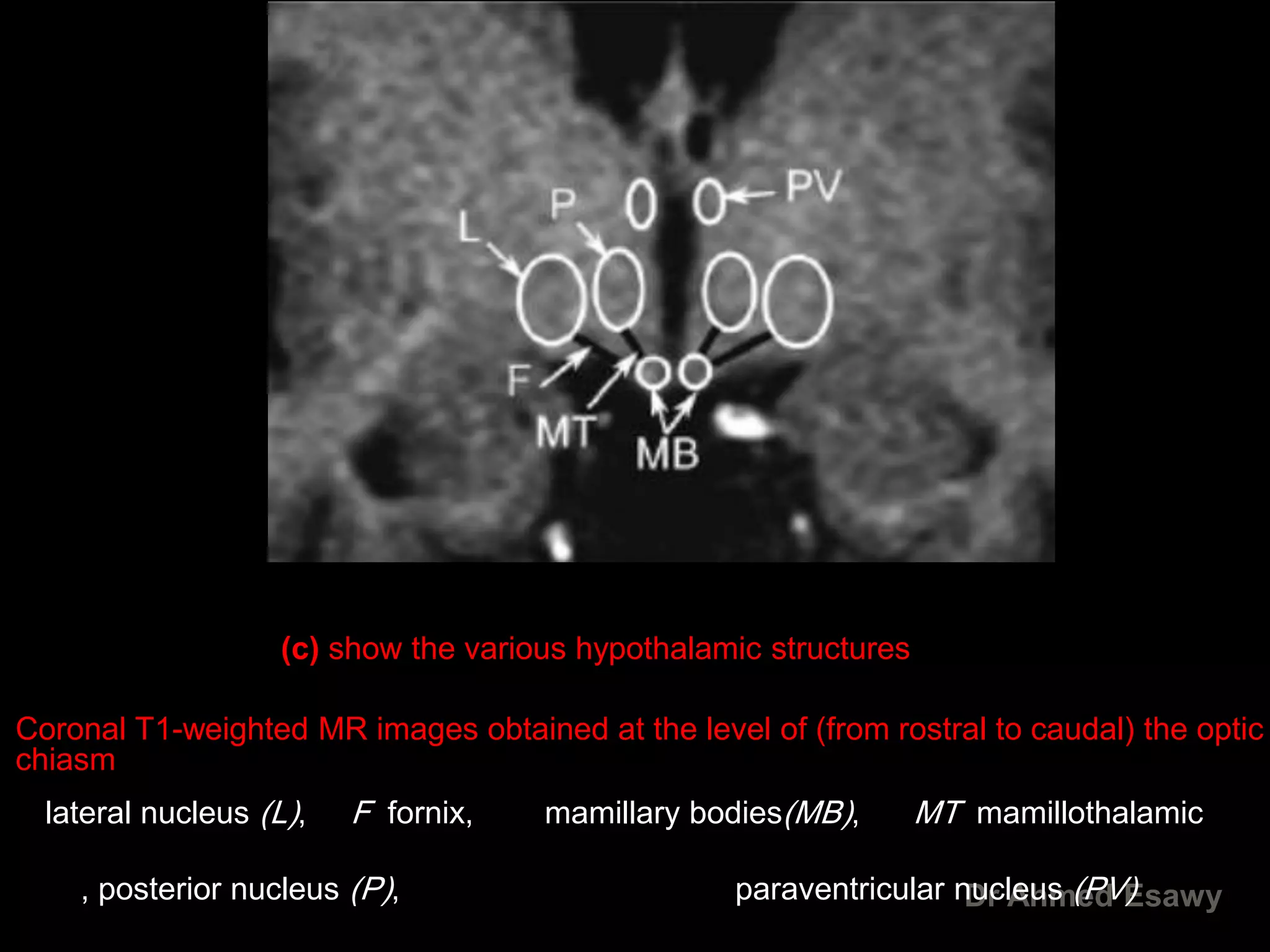 MRI imaging hypothalamus Dr Ahmed Esawy | PDF