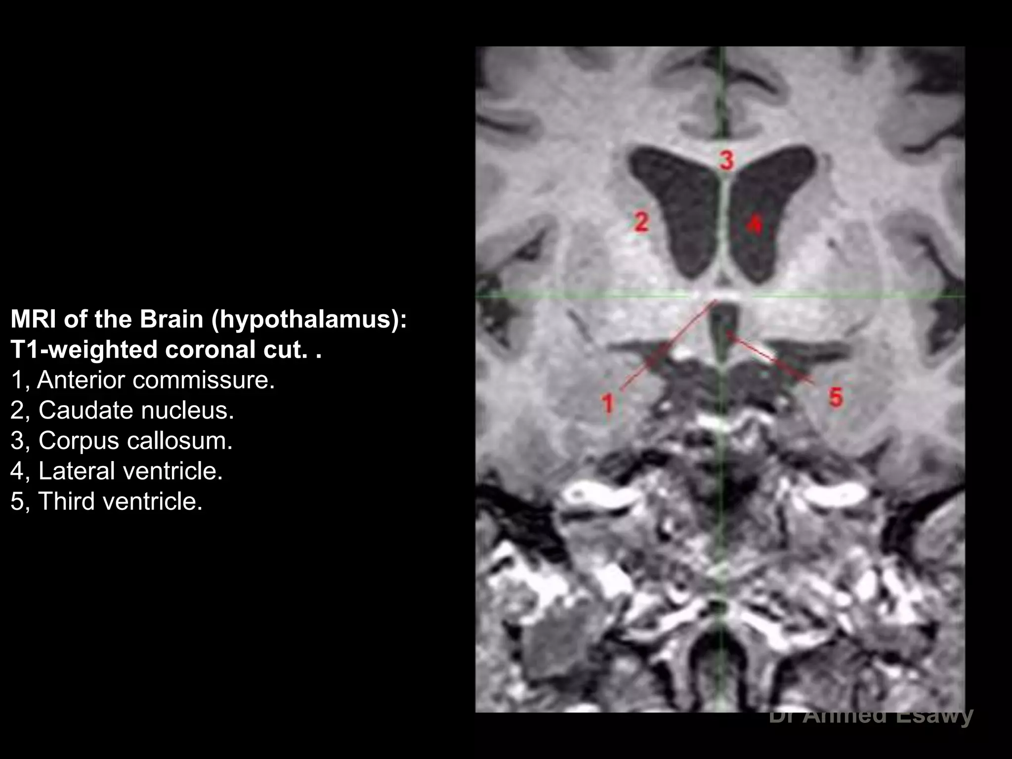 MRI imaging hypothalamus Dr Ahmed Esawy | PDF