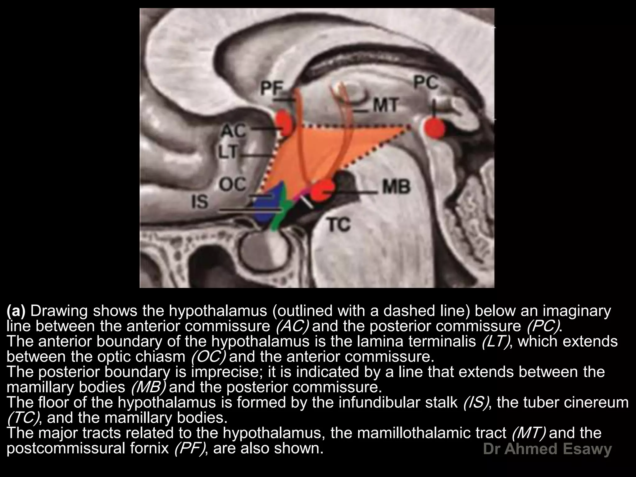 MRI imaging hypothalamus Dr Ahmed Esawy | PDF