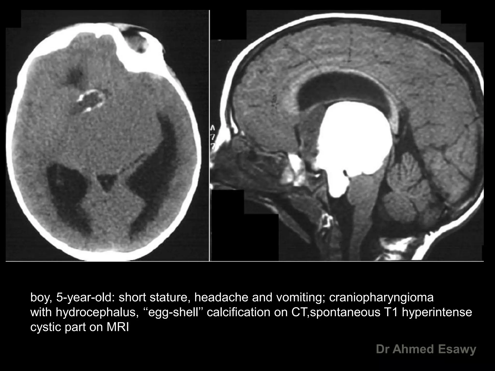 MRI imaging hypothalamus Dr Ahmed Esawy | PDF