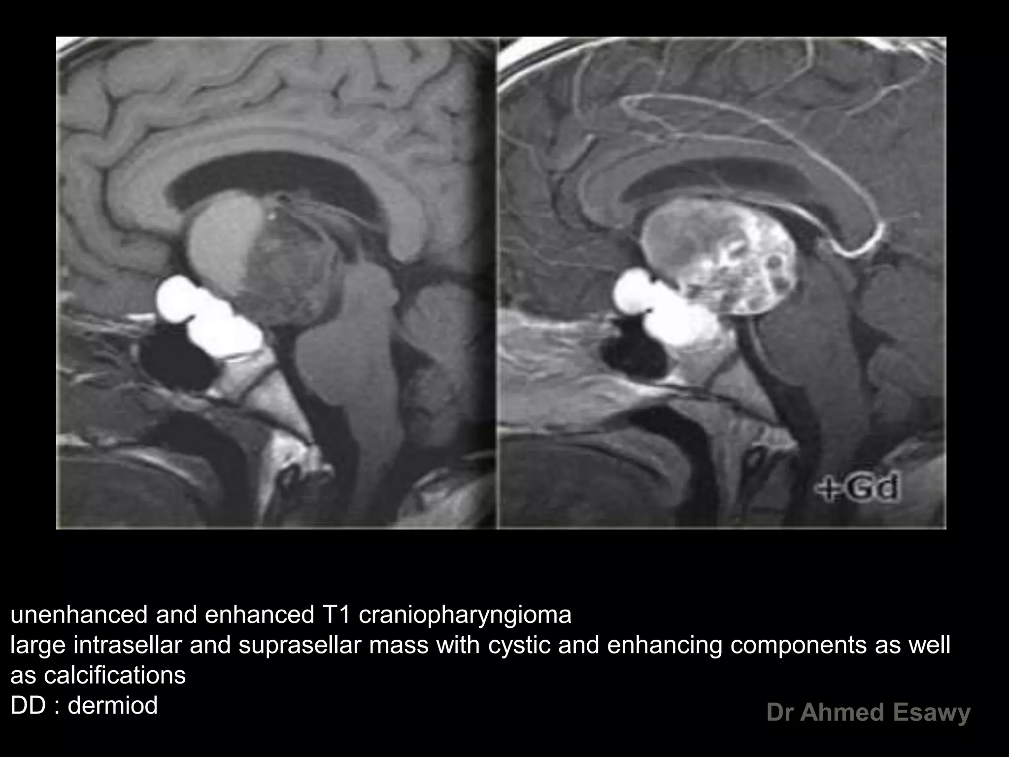 MRI imaging hypothalamus Dr Ahmed Esawy | PDF