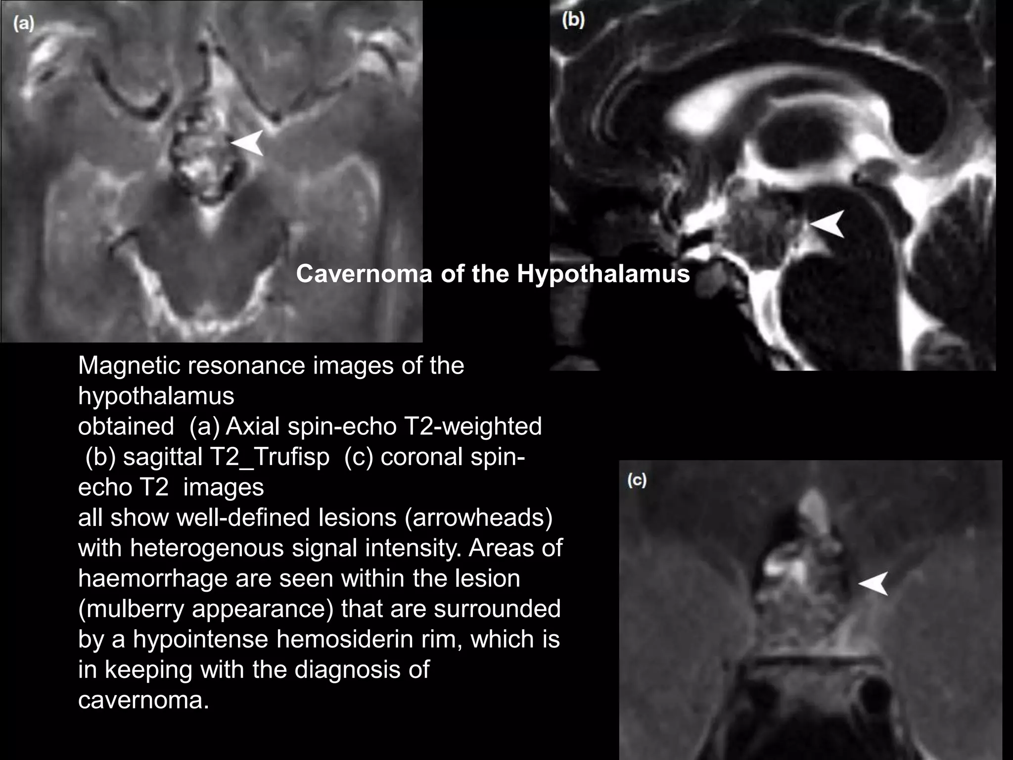 MRI imaging hypothalamus Dr Ahmed Esawy | PDF