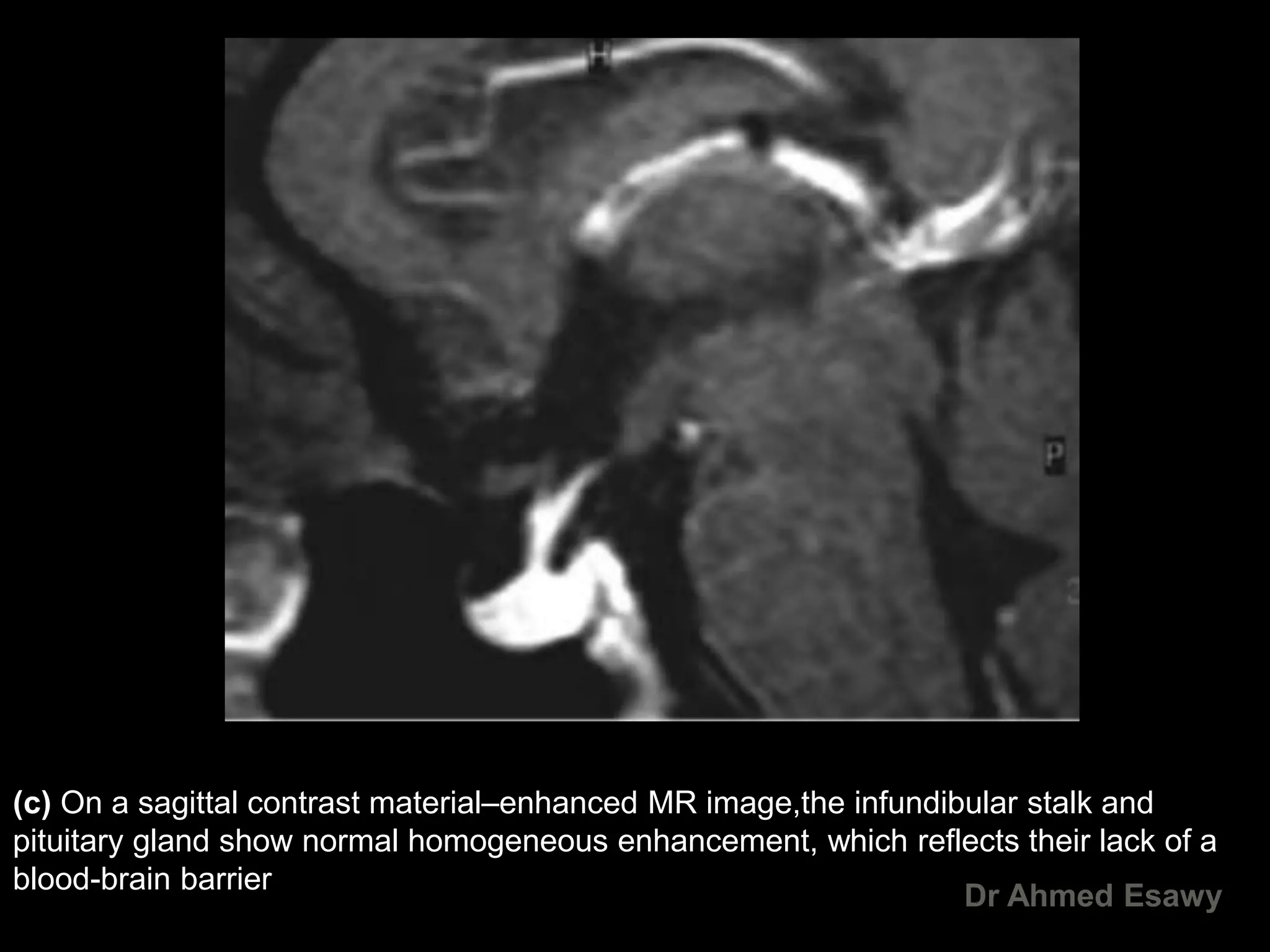 MRI imaging hypothalamus Dr Ahmed Esawy | PDF