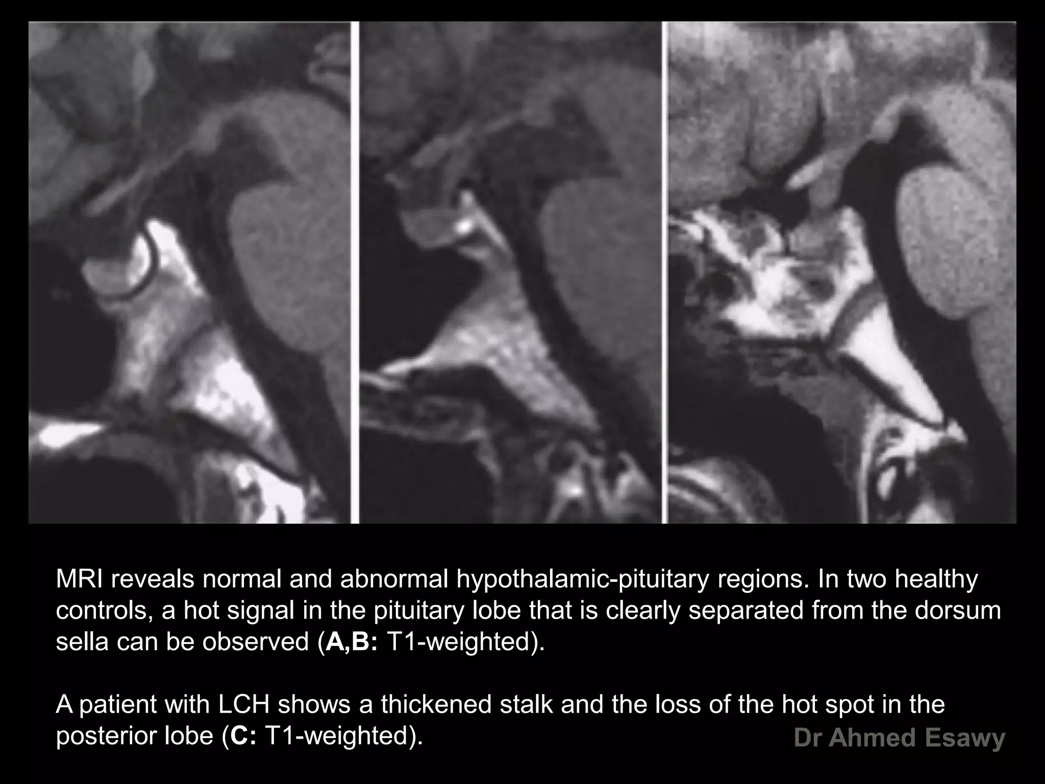 MRI imaging hypothalamus Dr Ahmed Esawy | PDF