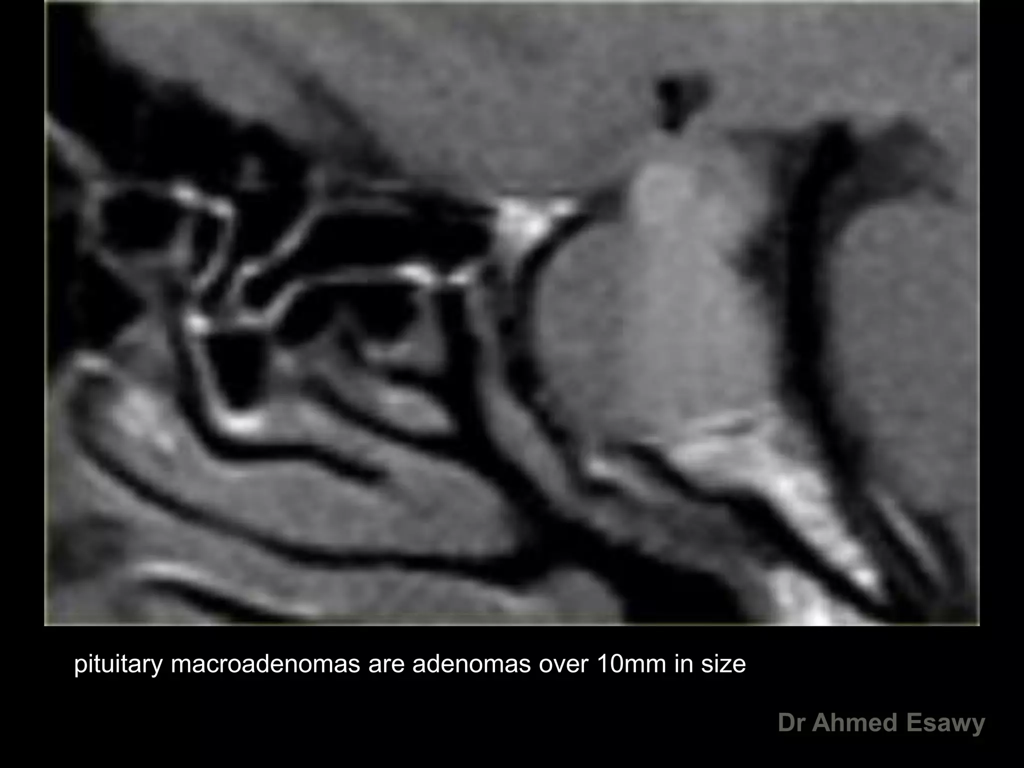 MRI imaging hypothalamus Dr Ahmed Esawy | PDF