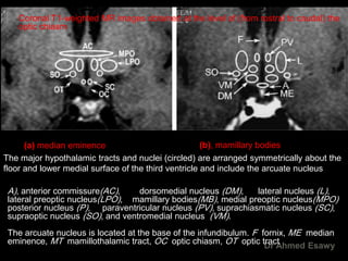 Hypothalamic Nuclei Coronal
