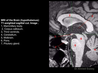 Mammillary Bodies Mri