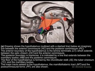 Lamina Terminalis Mri