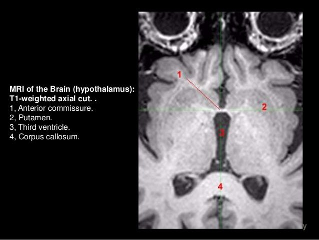 MRI imaging hypothalamus Dr Ahmed Esawy