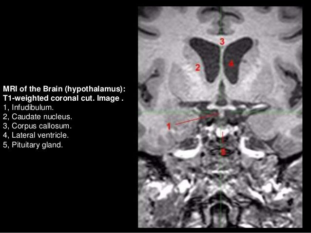 MRI imaging hypothalamus Dr Ahmed Esawy