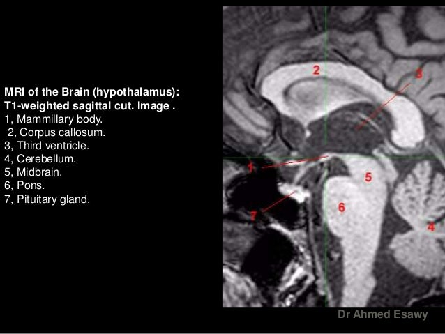MRI imaging hypothalamus Dr Ahmed Esawy