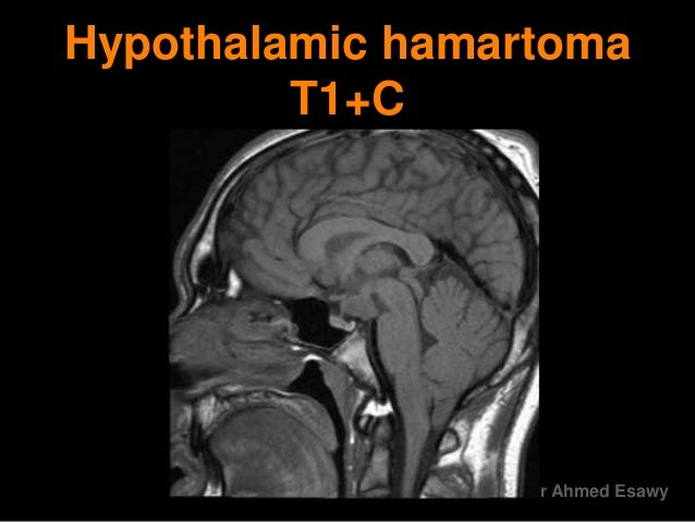 MRI imaging hypothalamus Dr Ahmed Esawy