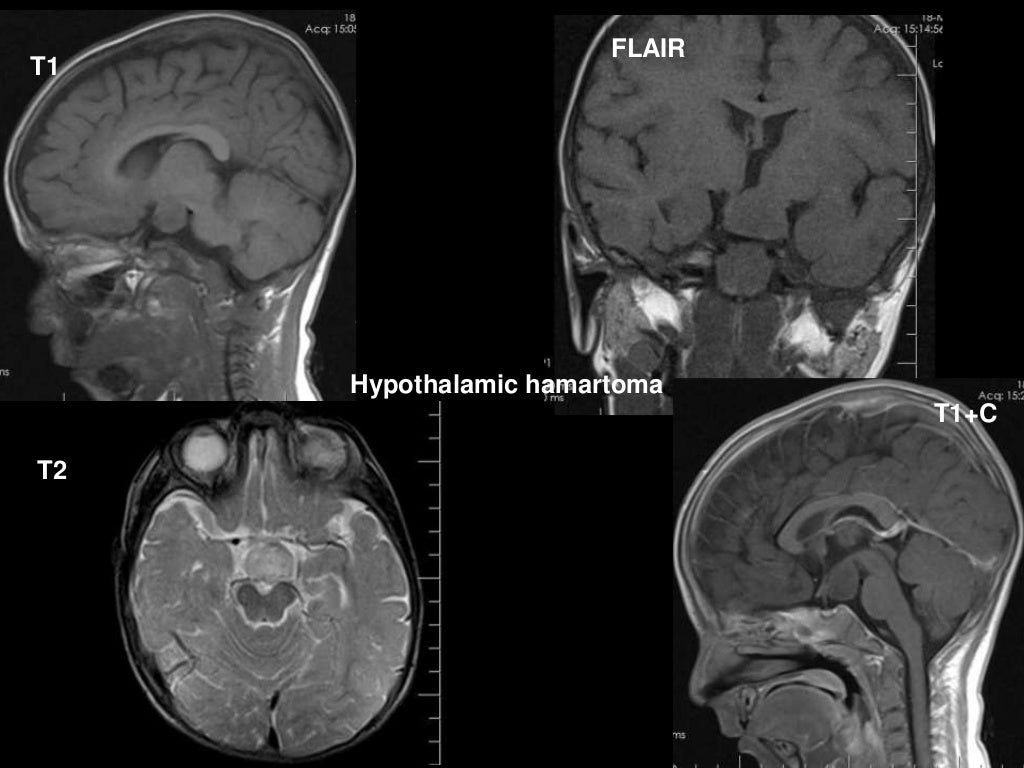 MRI imaging hypothalamus Dr Ahmed Esawy