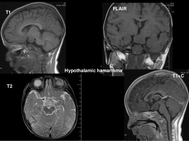 MRI imaging hypothalamus Dr Ahmed Esawy