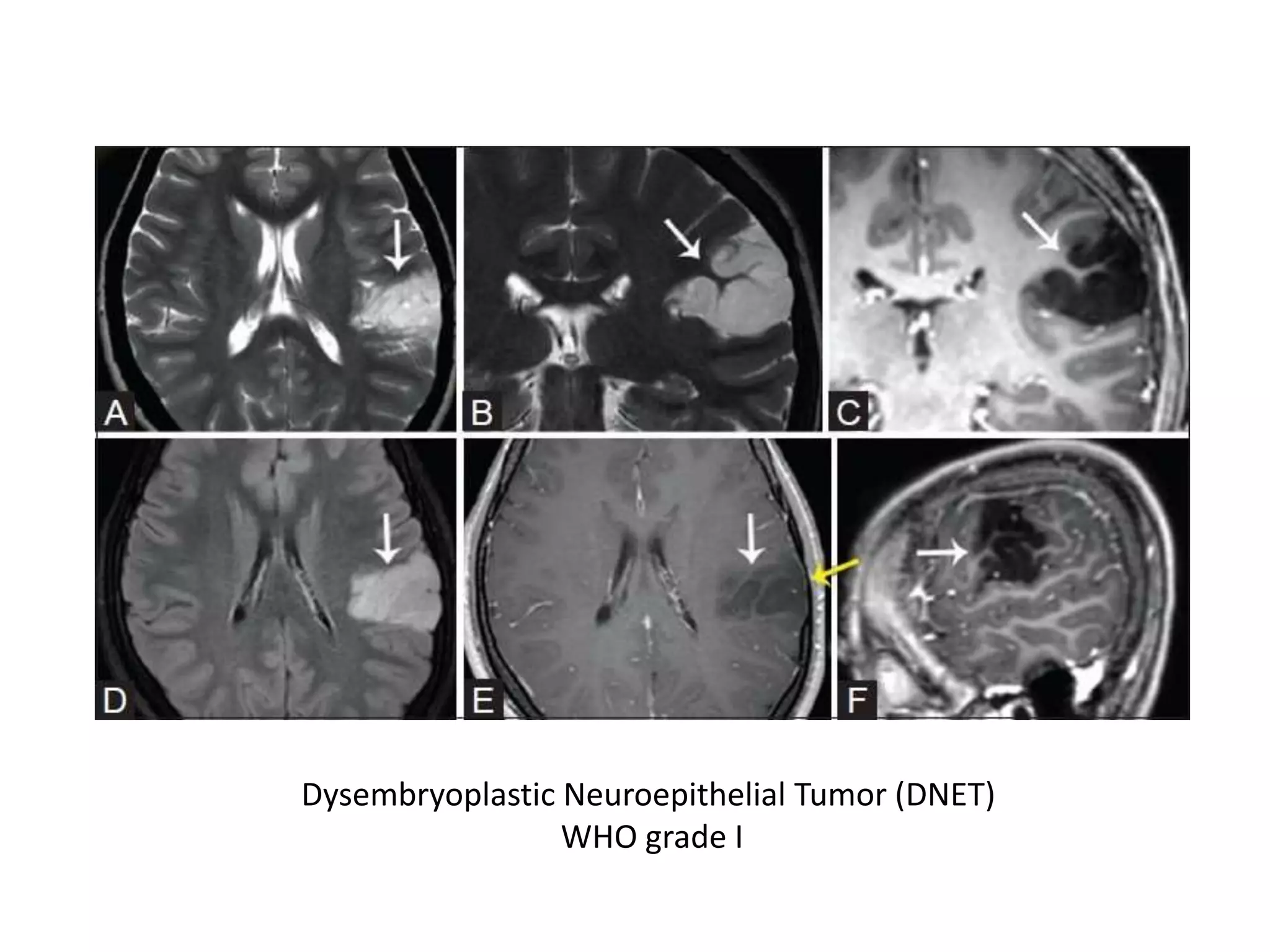 MRI imaging of brain tumors. A practical approach. | PPTX
