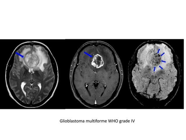 MRI imaging of brain tumors. A practical approach. | PPTX